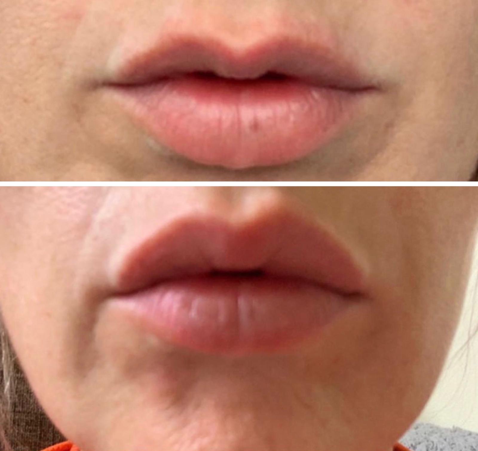 Facial Aesthetics - Horton Dental